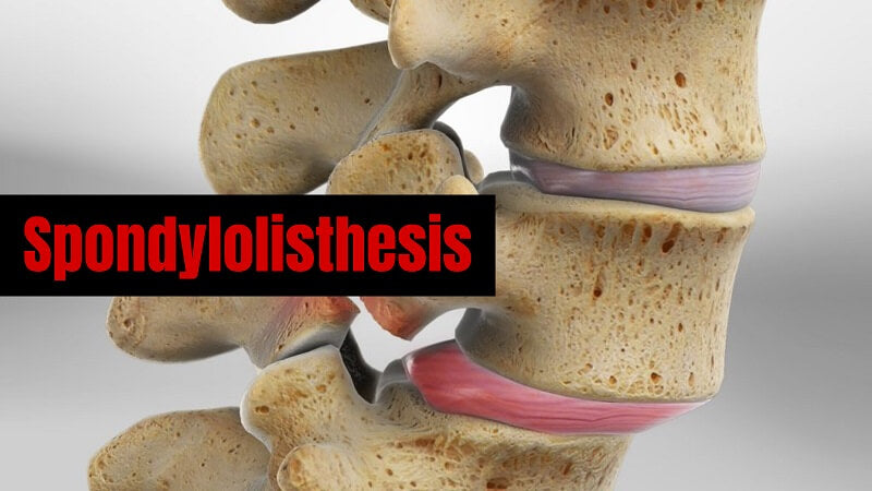 Spondylolisthesis - Symptoms, Causes and Treatments – OrthoRelieve